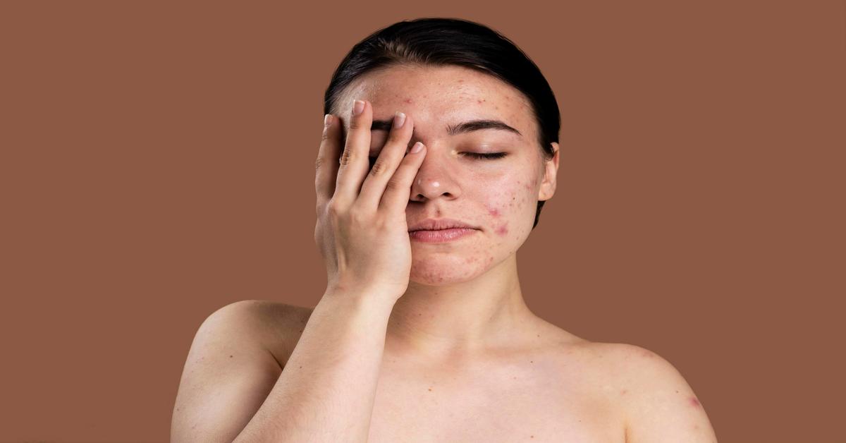 Chin Acne – Causes, Treatments, And Real Solutions That Actually Work